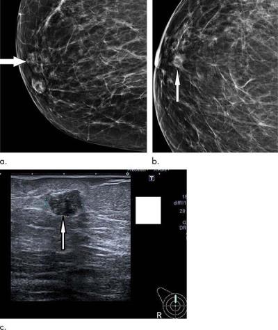 Digital Mammography Increases Breast Cancer Detection | RSNA
