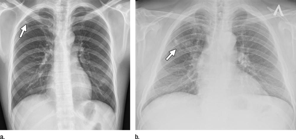 Research Showing AI May Help Diagnose Tuberculosis in Remote Areas ...