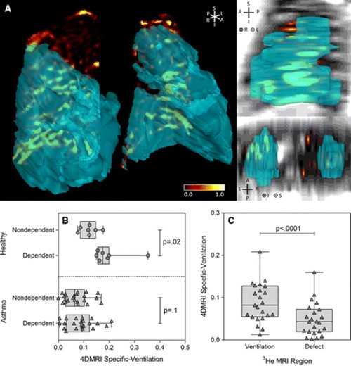 MRI Technique Shows Promise for Measuring Abnormal Lung Function | RSNA