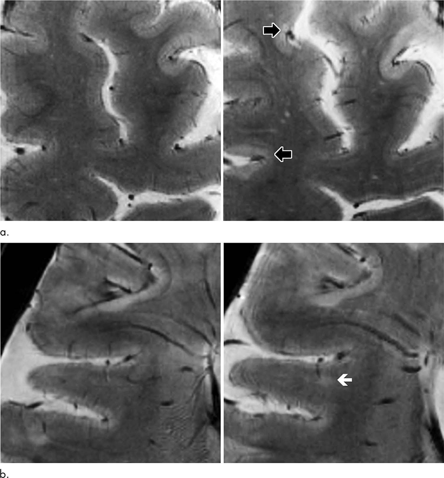 High-Strength MRI Tracks MS Progression | RSNA
