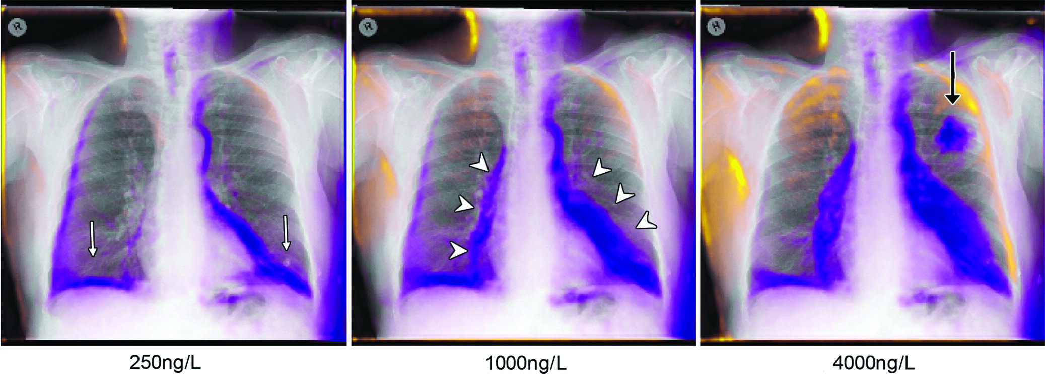 Deep Learning Model Visualizes Congestive Heart Failure | RSNA