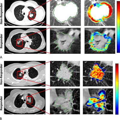 Radiomics-Predicts-Chemotherapy-Needs | RSNA