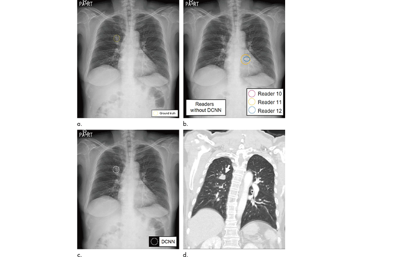 Deep-Learning-For-Detecting-Lung-Cancers | RSNA
