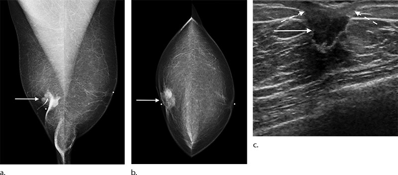 Screening Mammography Could Benefit Men at High Risk of Breast Cancer ...