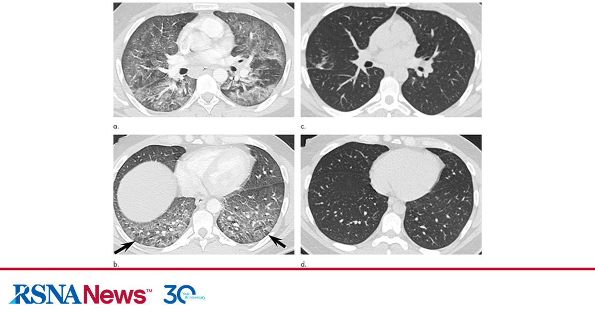 Vaping Patterns On Lung Ct