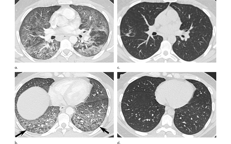 Vaping-Patterns-On-Lung-CT | RSNA