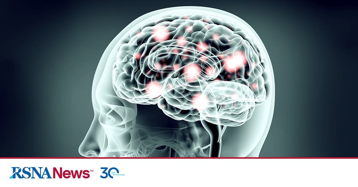 Deep-Brain-Stimulation-For-Depression | RSNA