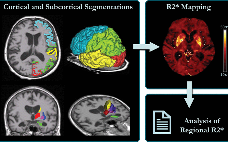 Brain-Iron-Accumulation | RSNA