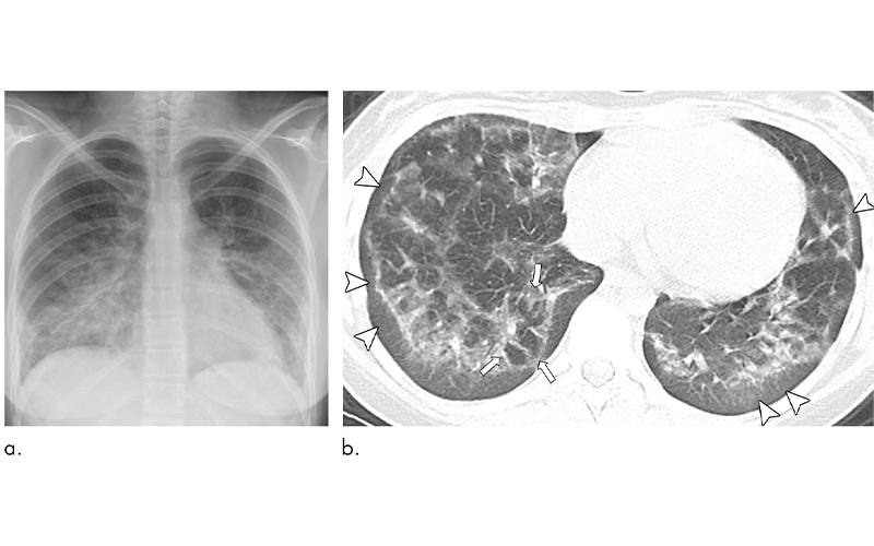 EVALI-Findings-In-Teens | RSNA