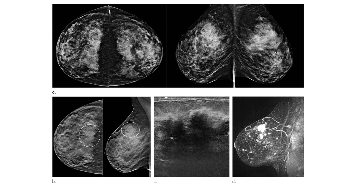 Tomosynthesis-Versus-Digital-Mammography | RSNA