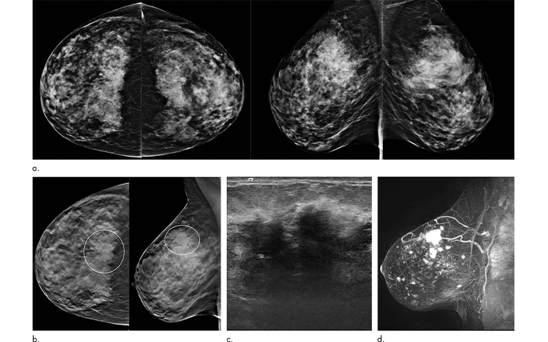 Tomosynthesis-Versus-Digital-Mammography | RSNA