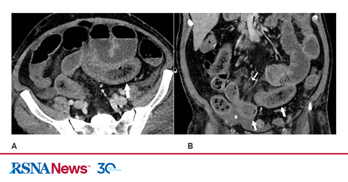 COVID-19-Bowel-Abnormalities | RSNA