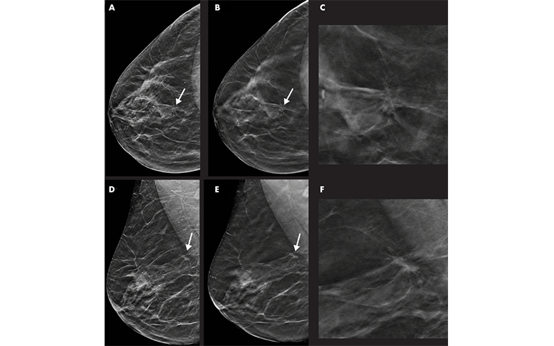 tomosynthesis-with-synthetic-mammography-for-breast-cancer-detection | RSNA