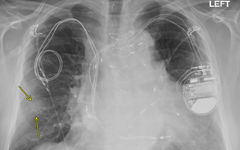 mri-for-patients-with-icds | RSNA