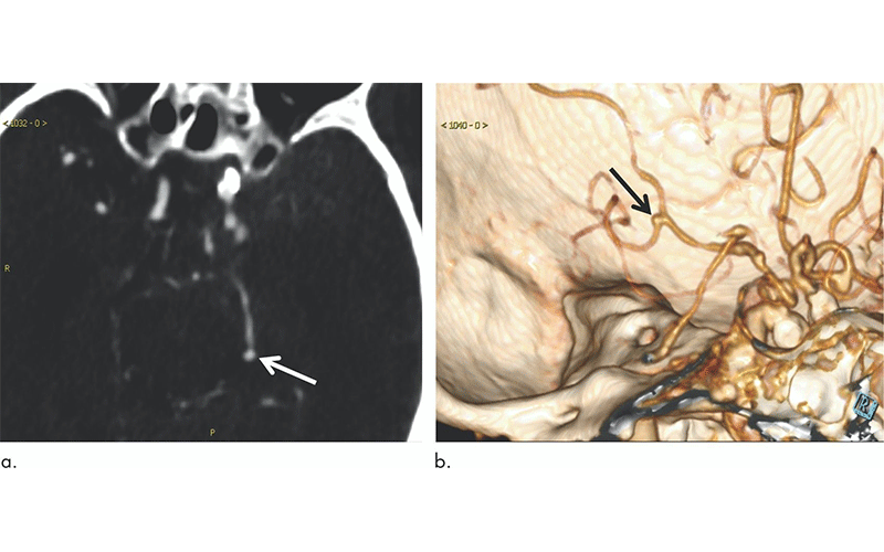ai-for-brain-aneurysms-on-ct-angiography | RSNA