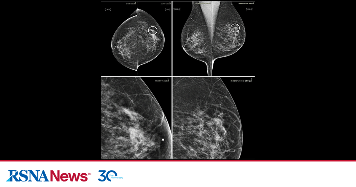 ai-breast-cancer-detection-on-mammography | RSNA