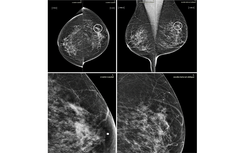 ai-breast-cancer-detection-on-mammography | RSNA