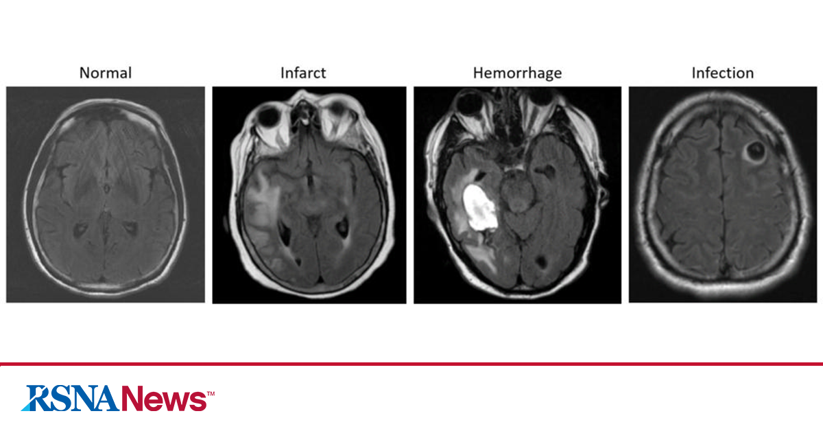 AI Brain MRI Triage | RSNA
