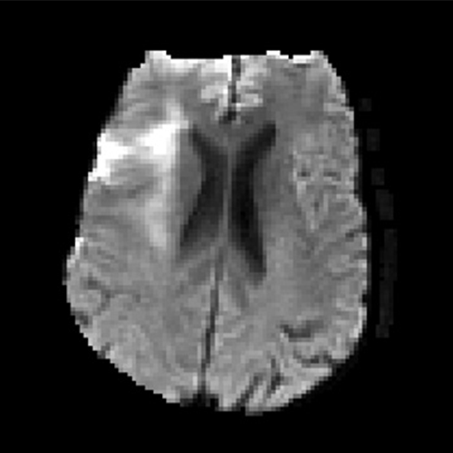 Acute Ischemic Stroke | RSNA