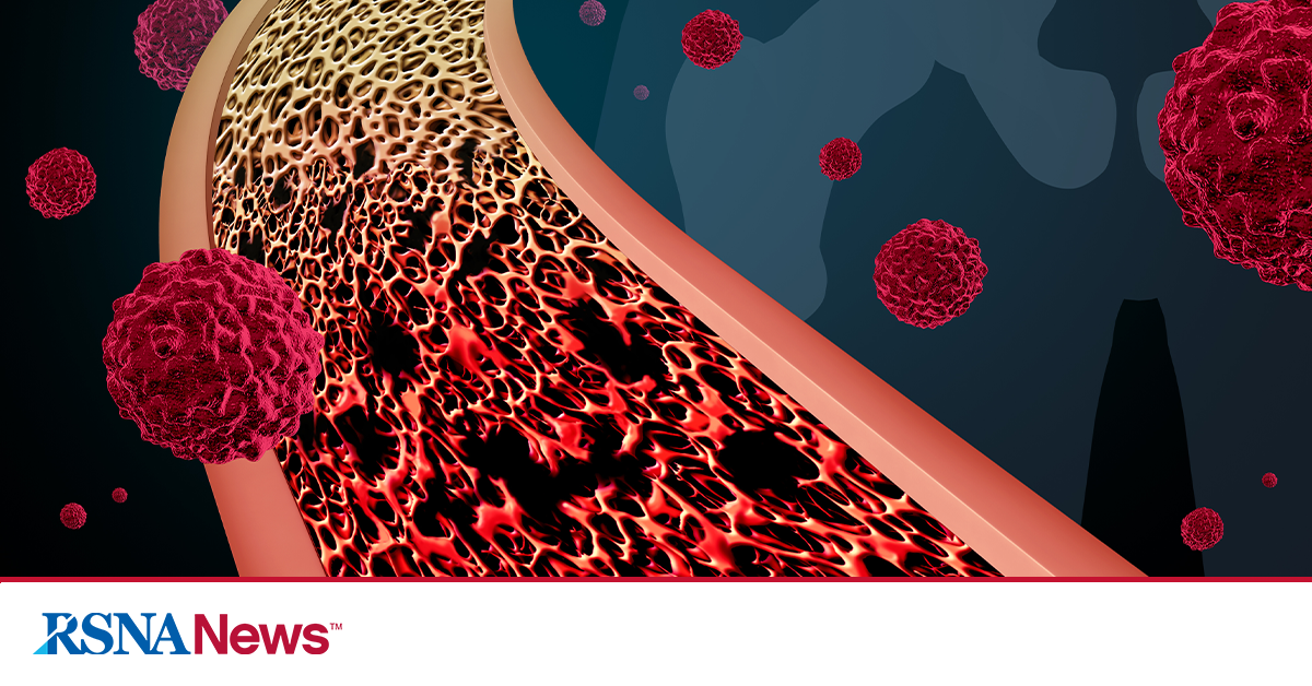 Cryoablation Bone Metastasis | RSNA