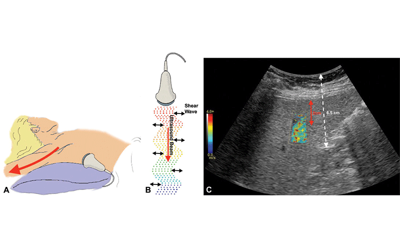Ultrasound Elastography Proves an Effective Tool for Diagnosing Hepatic ...