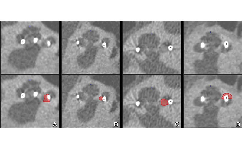Cochlear-Implants | RSNA