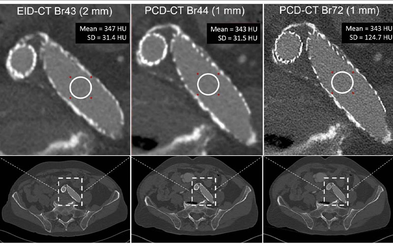 Photon-Counting-CT-System | RSNA