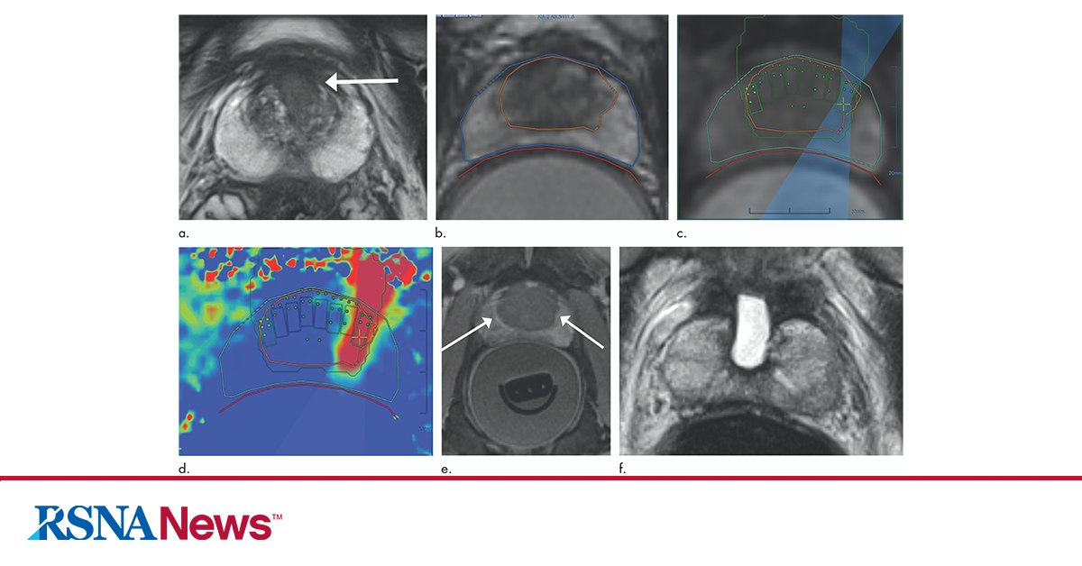 Ultrasound Technique Treats Prostate Cancer | RSNA