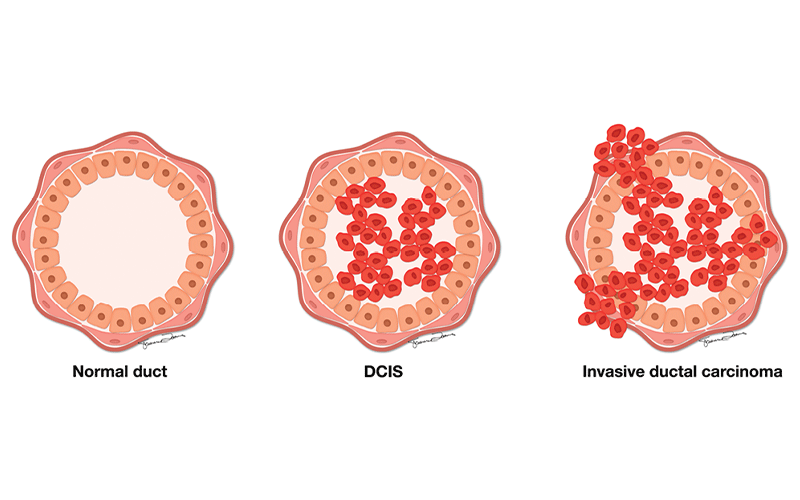 Machine Learning Breast Cancer | RSNA