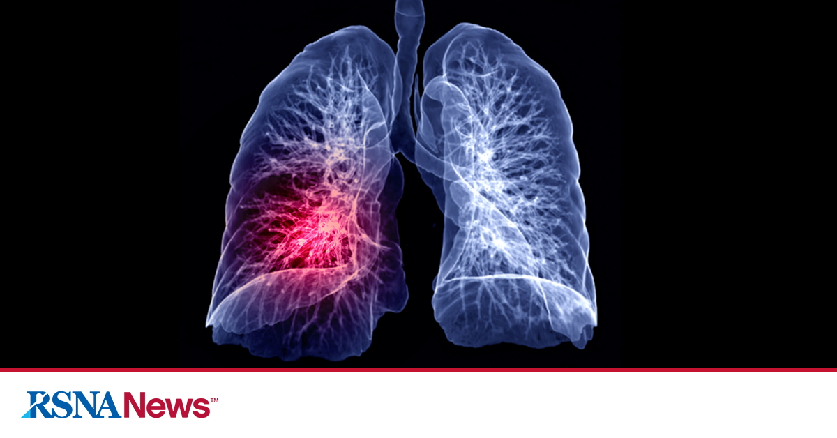 Social Determinants Reveal Stark Differences in Lung Cancer Screening ... Social Determinants Reveal Stark Differences in Lung Cancer Screening ...