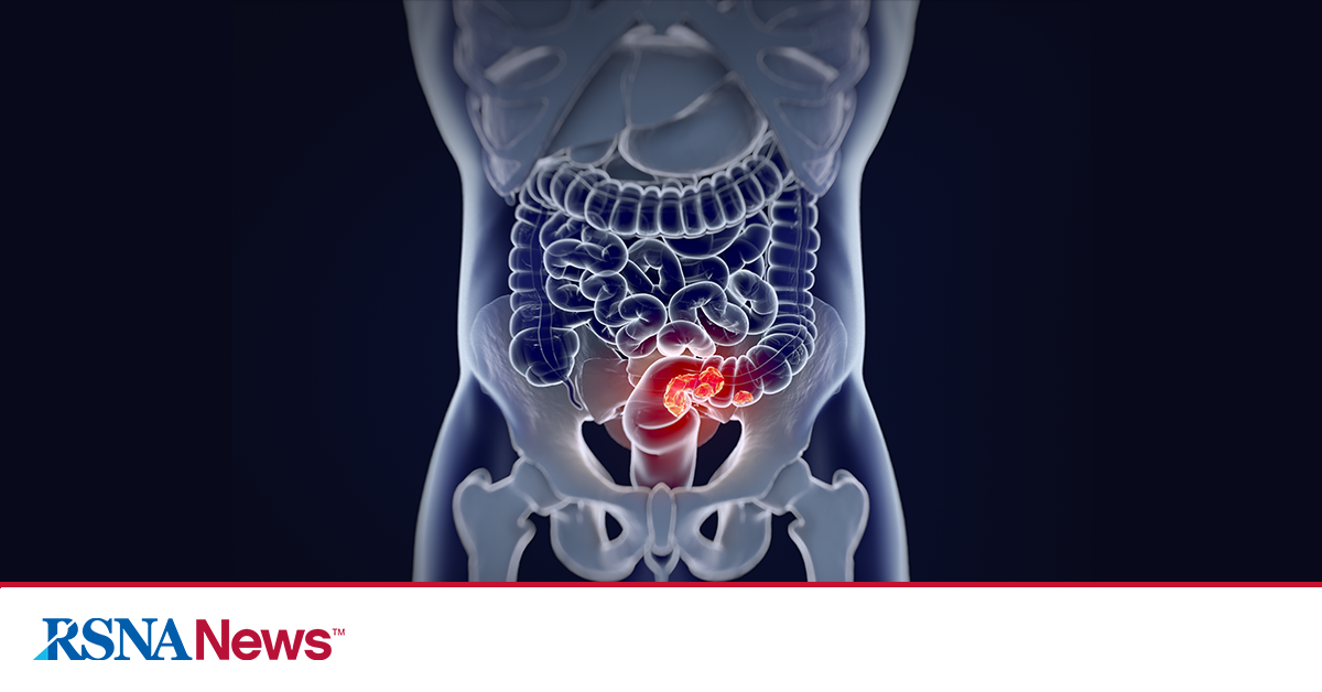 Radiomics For Advanced Colorectal Cancer | RSNA