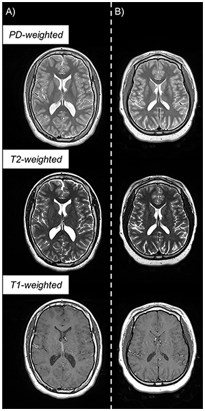 MRI For Atypical Brain Development Children | RSNA