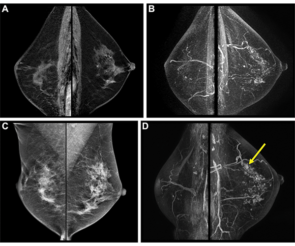 Breast MRI Illuminates Risk | RSNA