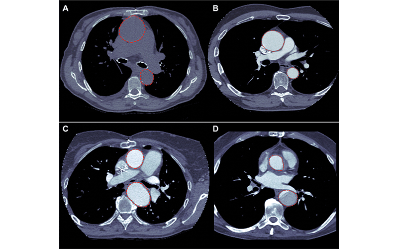 AI For Aneurysms | RSNA