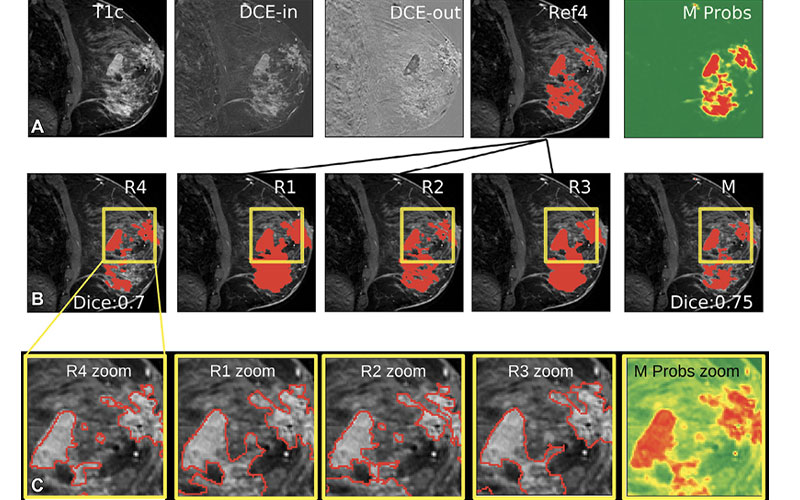 Automatic Segmentation Breast Tissue | RSNA