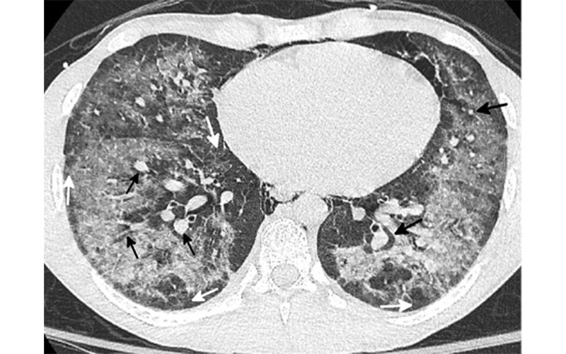 EVALI Diagnosis | RSNA