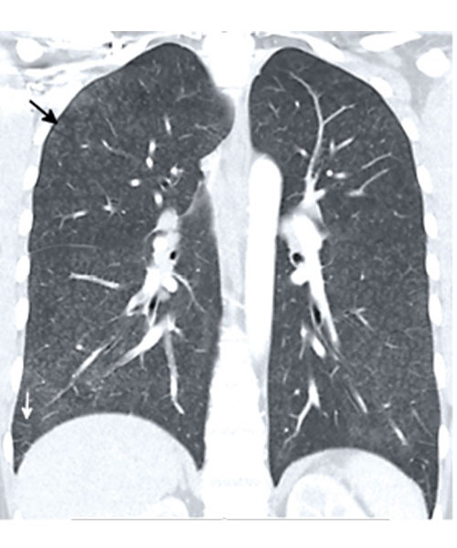 EVALI Diagnosis | RSNA