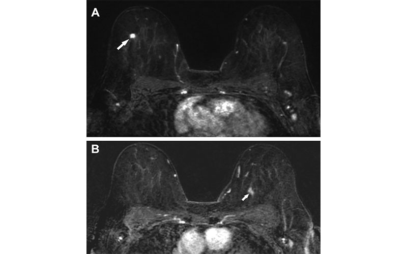 MRI Screening For Contralateral Breast Cancer | RSNA