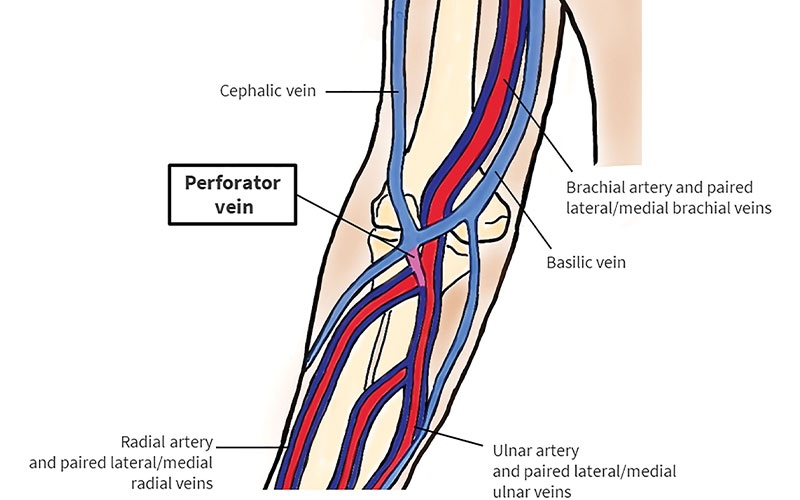 Fistula For Dialysis Placement
