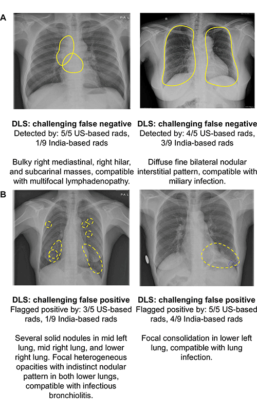 Deep Learning Tuberculosis Detection | RSNA
