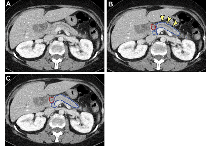 Pancreatic Cancer Detection | RSNA