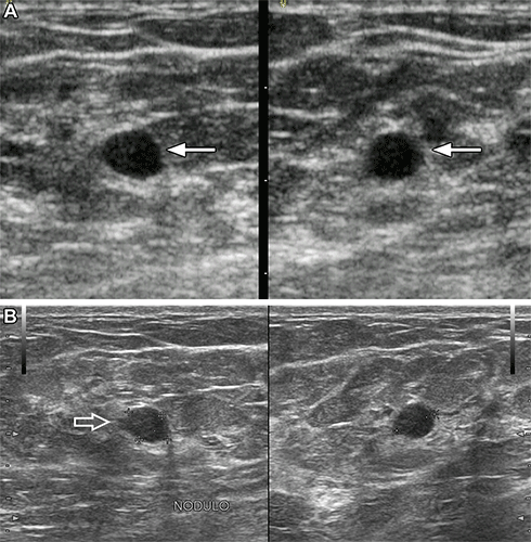 AI Helpful in Triaging Breast Masses in Low-Resource Areas | RSNA