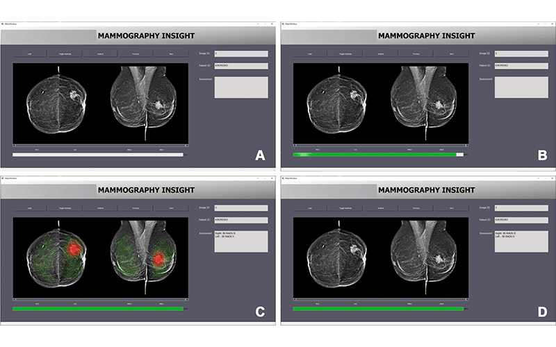 AI Bias May Impair Radiologist Accuracy on Mammogram | RSNA