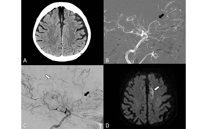 Thrombectomy Comparable to Medical Management for Strokes | RSNA