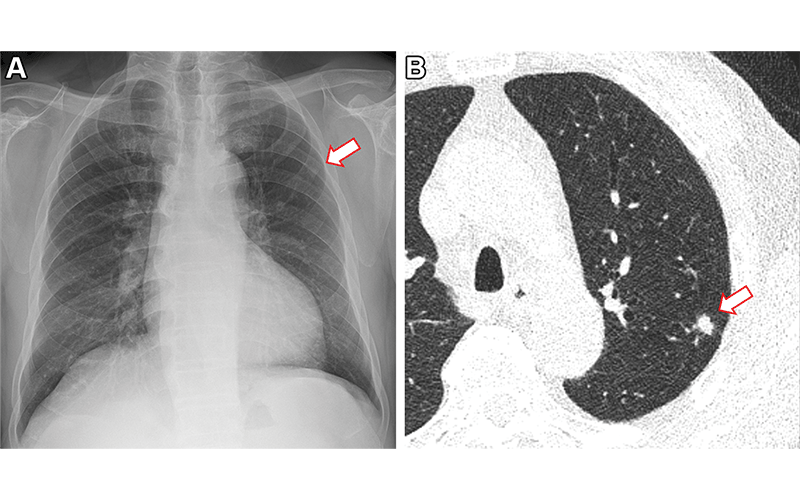 AI Improves Lung Nodule Detection | RSNA AI Improves Lung Nodule Detection | RSNA