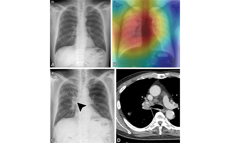 DL for Lung Cancer Screening Selection | RSNA