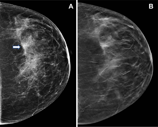 Study Finds Tomosynthesis Better for Breast Cancer Detection | RSNA