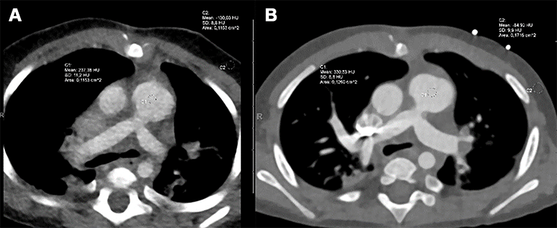 Photon-Counting CT Offers Superior Imaging in Babies with Heart Defects ...