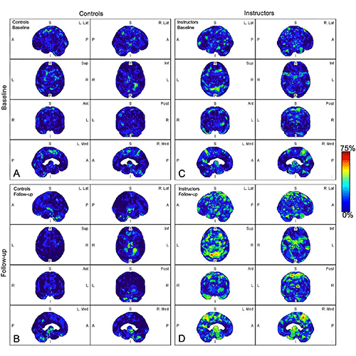 Recurrent Brain Trauma May Increase Alzheimer’s Risk | RSNA