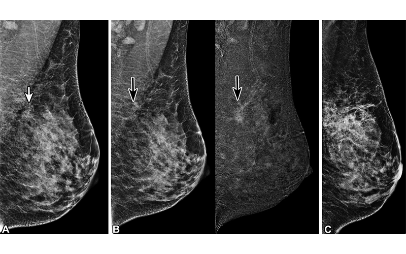 Assessing Radial Scars | RSNA